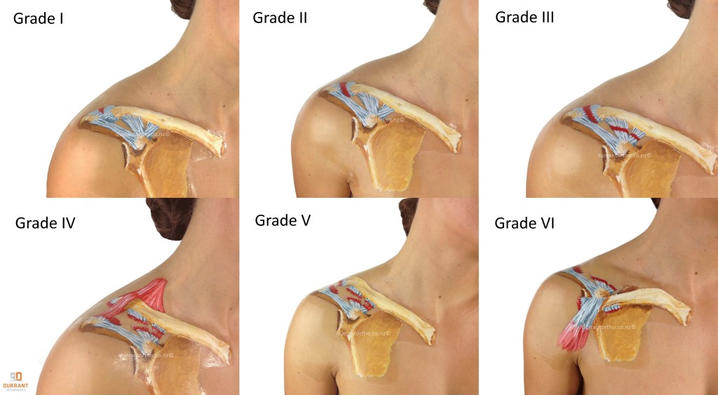AC Joint Pain What Is It And How Do I Fix It Physiosteps