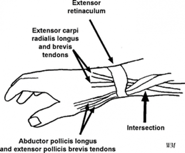 Wrist pain: Intersection Syndrome - Physiosteps